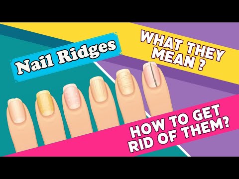 Vertical lines /Horizontal lines on Nails or Nail Ridges #nails