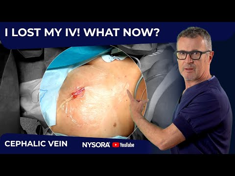 EMERGENT CEPHALIC VEIN CANNULATION TECHNIQUE