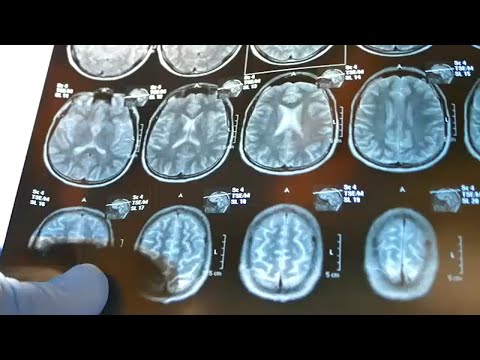 New brain tumor drug hits market 16 years after Duke neurosurgeon's discovery: ' Excited'