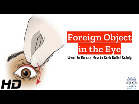 Foreign Object in the Eye: Step-by-Step Emergency Guide