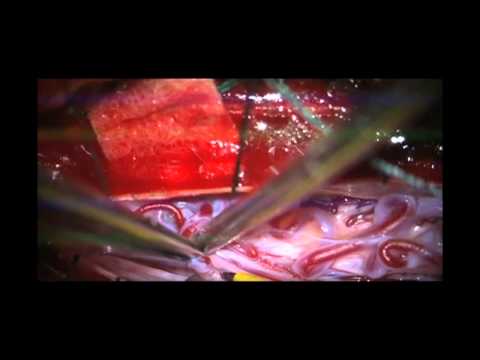 Spinal AVM