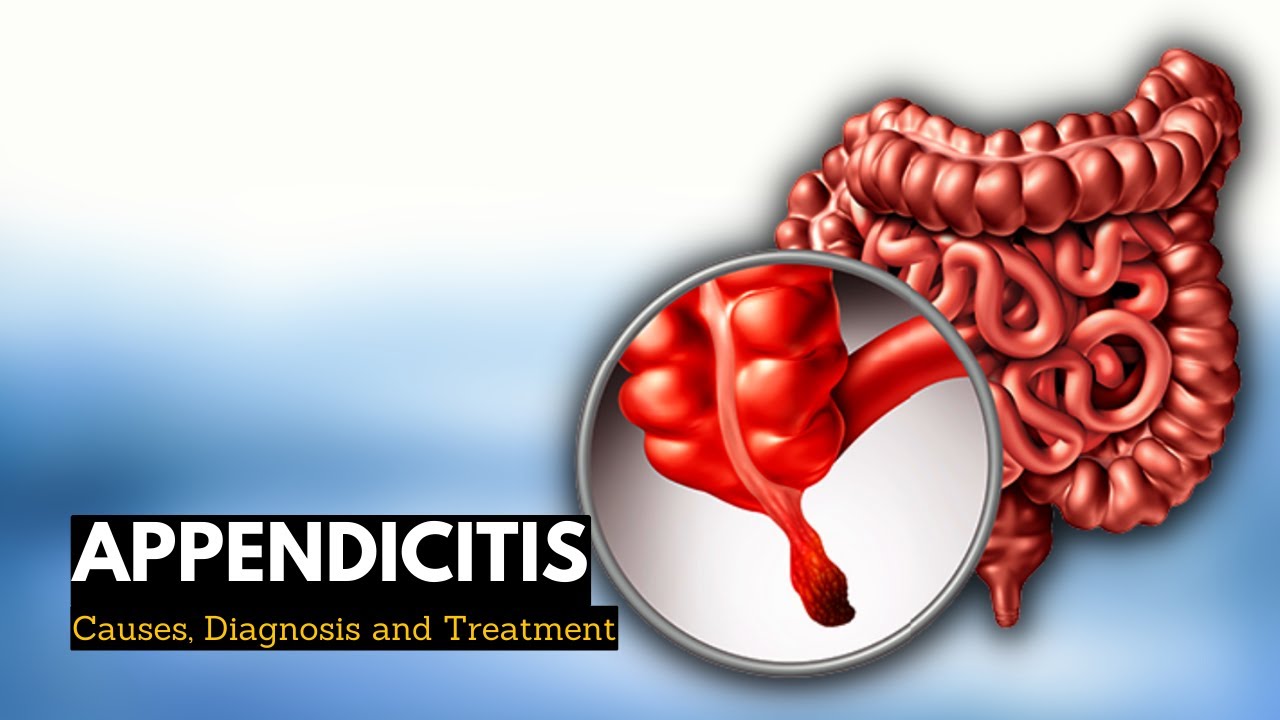 Appendicitis, Causes, Signs and Symptoms, Diagnosis and Treatment.