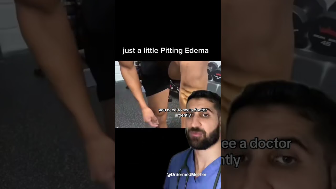 If Your Leg Does This When You Press, You Need to See a Doctor Urgently #swelling