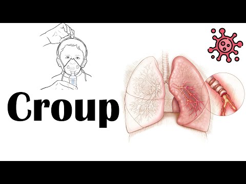 Croup - Causes, Pathogenesis, Signs & Symptoms, Diagnosis, & Treatment