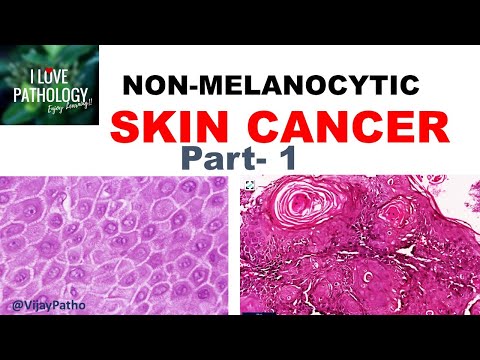 SKIN CANCER: Non Melanocytic: Part 1- Anatomy, Etiopathogenesis & Classification