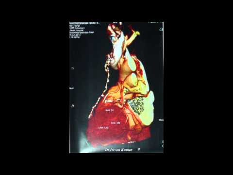 14 year long term follow up of CABG