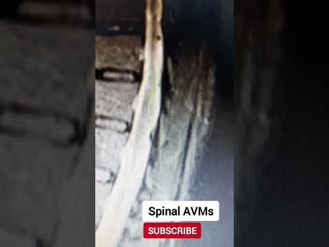 Spinal AVMs -Radiology