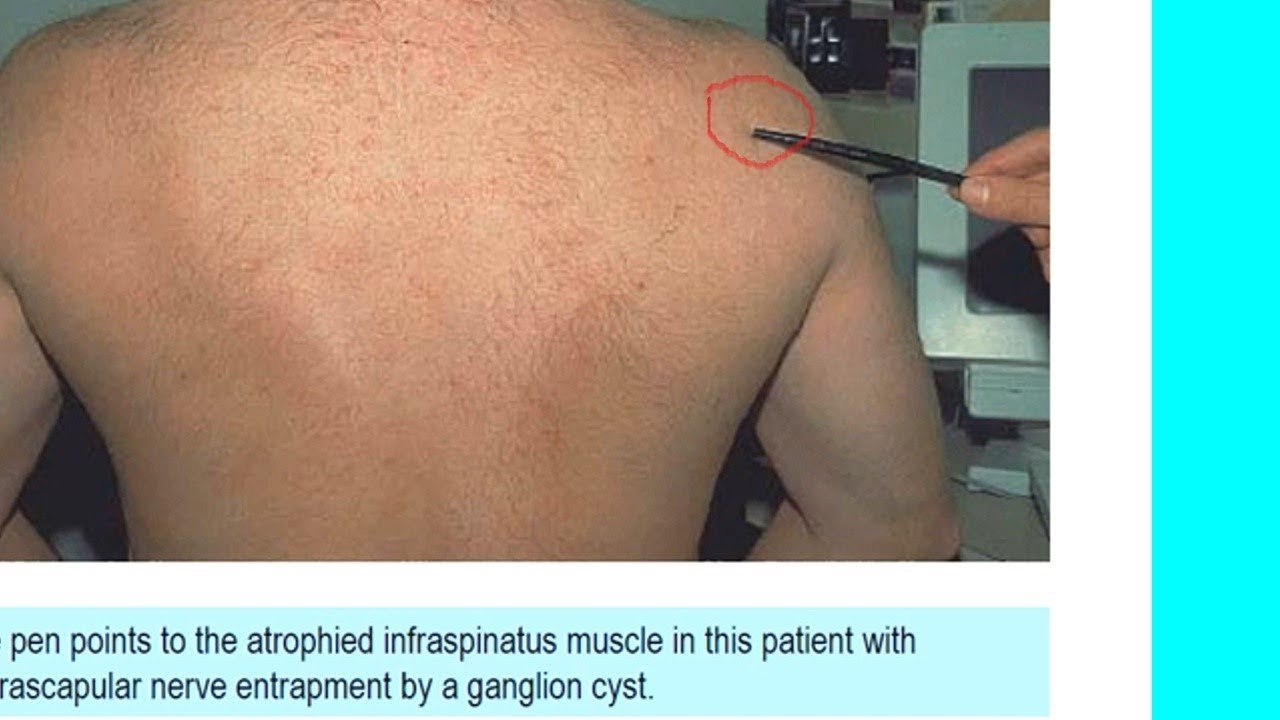 Suprascapular Neuropathy /Medical Documentary