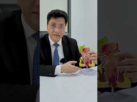 Understanding Your Grade of Piles at Home (Hindi) | अपने बवासीर का ग्रेड कैसे पहचानें