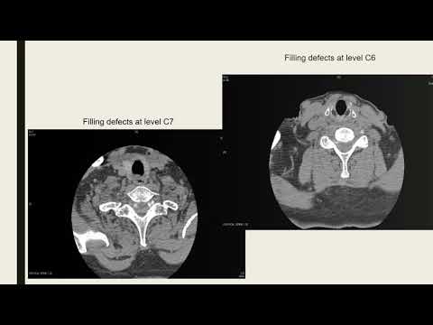 CT Cervical Myelogram