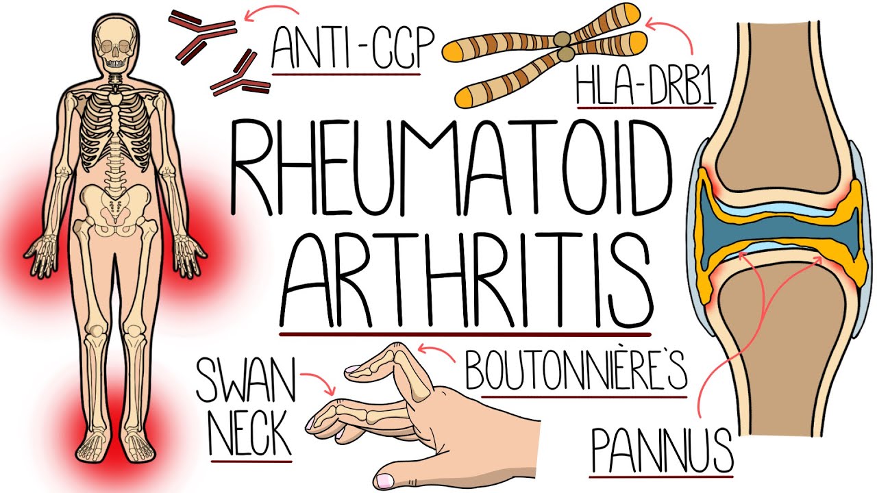 Rheumatoid Arthritis Explained Clearly
