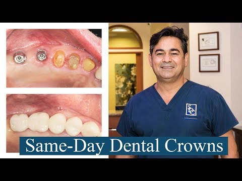 Cosmetic Dentist Dr. Michael Abaian Explains CEREC® Same-Day Dental Crowns in Sherman Oaks, CA