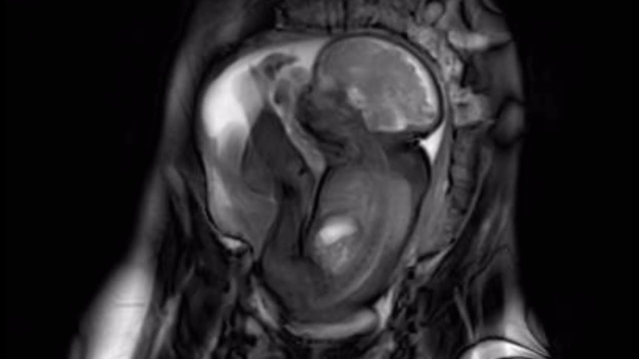 MRI Fetus 32 weeks