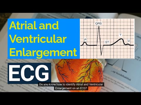 Identifying Atrial and Ventricular Enlargement on an ECG.