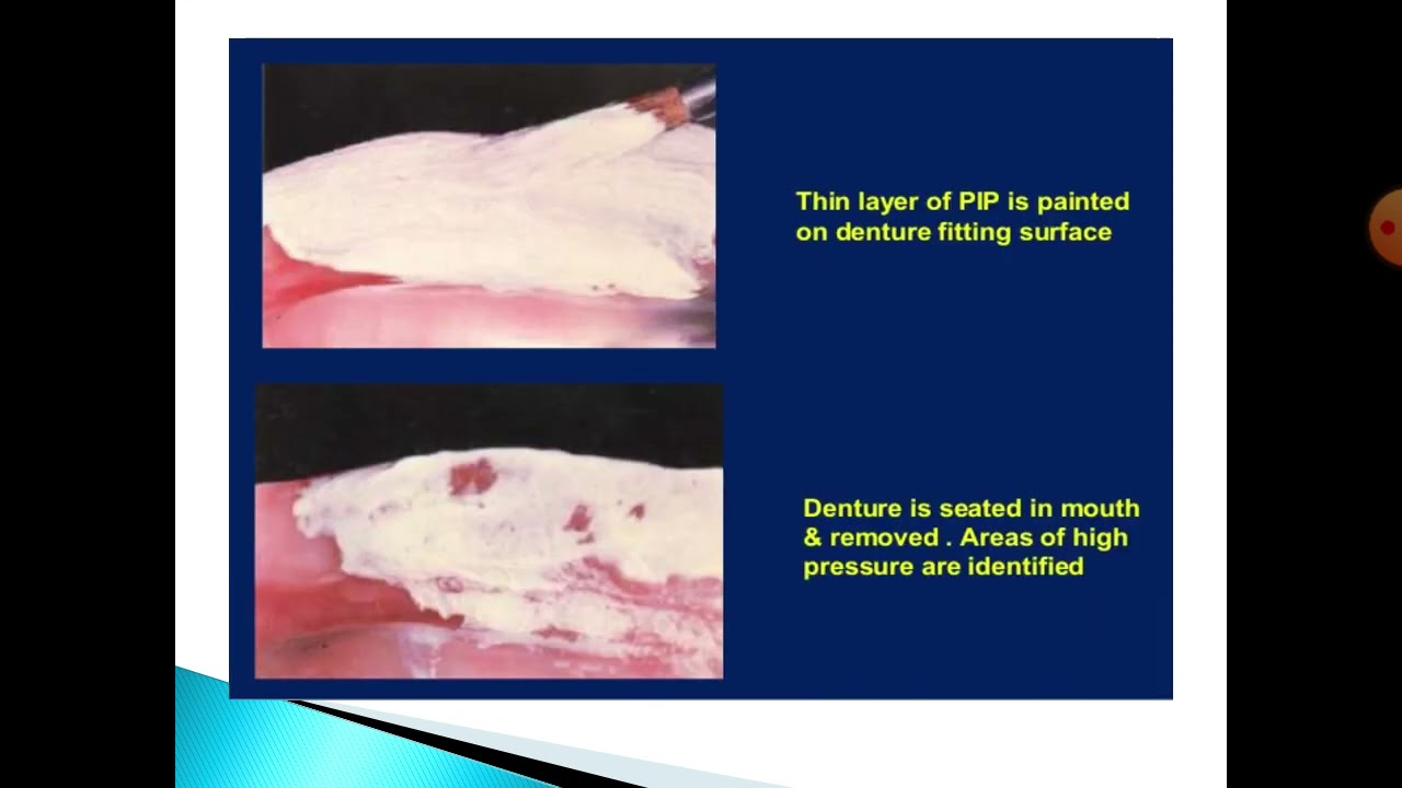 Complete denture insertion removable prosthodontics