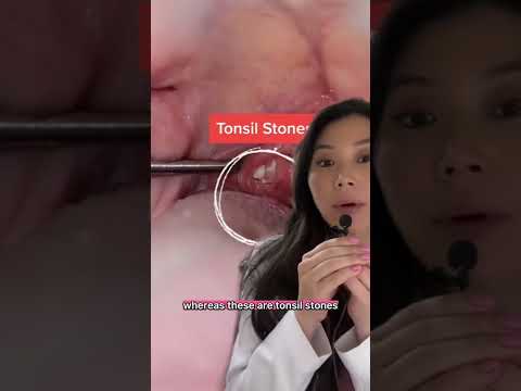 What inflamed tonsils look like vs normal tonsils #tonsilstones