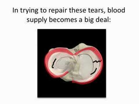 What is a knee meniscus tear? www.regenexx.com