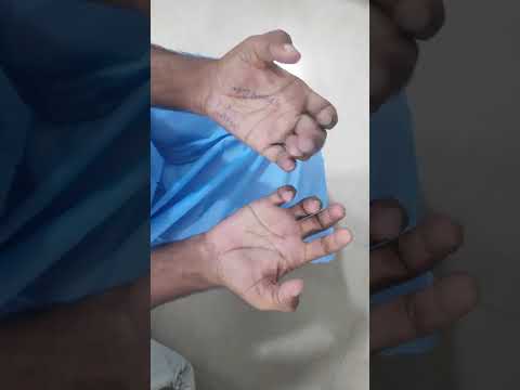 Grip and Release Test - Cervical Myelopathy