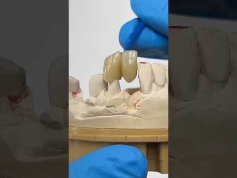 Monet Pure Zirconia Cantilever Bridge #lsk121shorts #dental #teeth