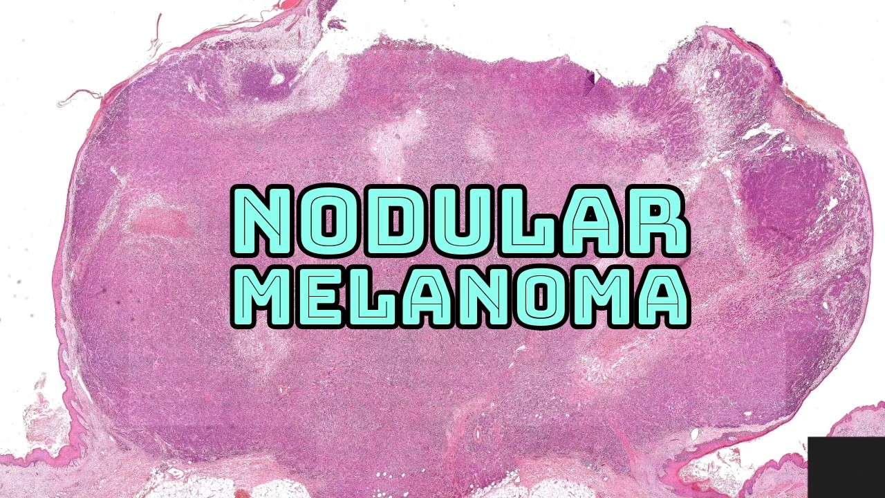 Nodular Melanoma with satellite lesion (pathology dermpath dermatology dermatopathology)