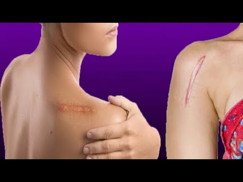 Scar Tissue Pain: Treatment