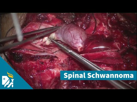 Spinal Schwannoma