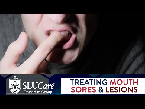 Mouth Sores & Lesions: Diagnosing and Treatment - SLUCare Otolaryngology