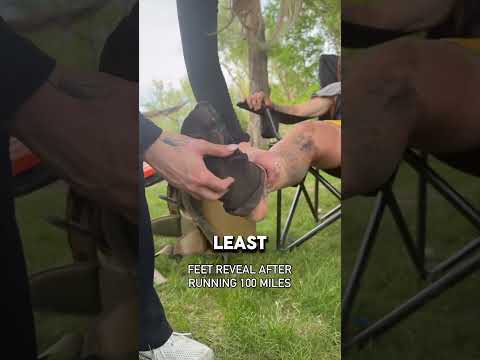 Feet After a 100 Mile Marathon