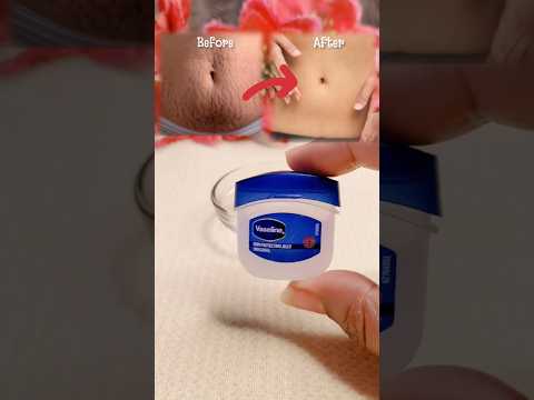 Stretch Marks Removal Cream at Home ???? #viral #stretchmarks #skincare #stretchmarkscream #shorts