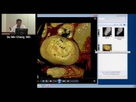 Coronary Imaging with CTA: Methodology, Advantages and Pitfalls (Su Min Chang, MD) November 1, 2016