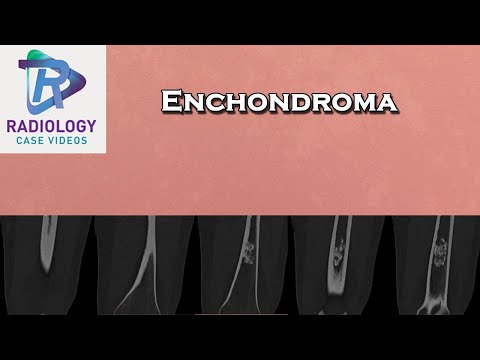 Enchondroma