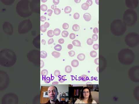 Hgb SC Disease Morphology Characteristics