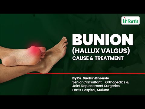 What Is The Main Cause Of Bunion (Hallux Valgus)? | Bunion Treatment And Surgery | MUL