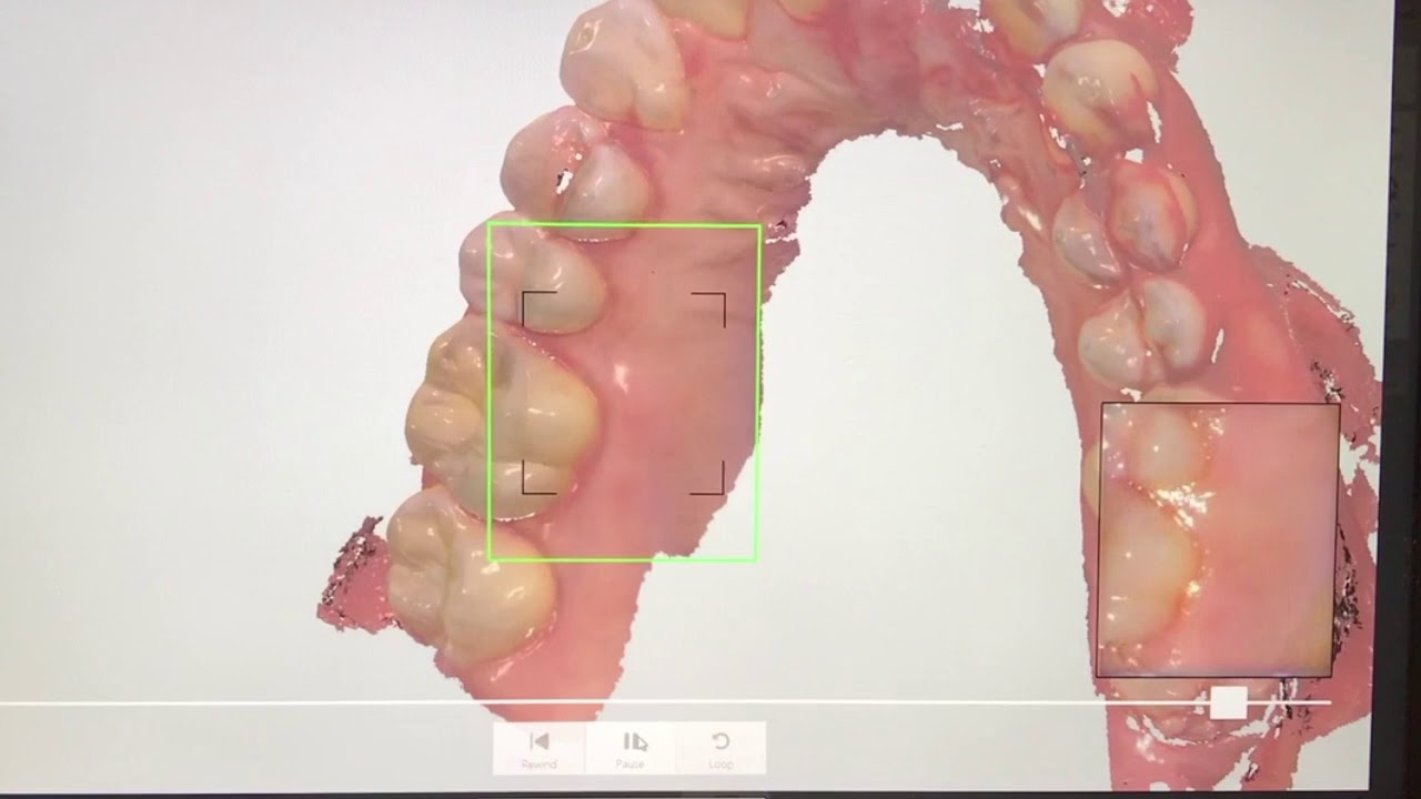 Digital Impression of Single Implant at Surgery