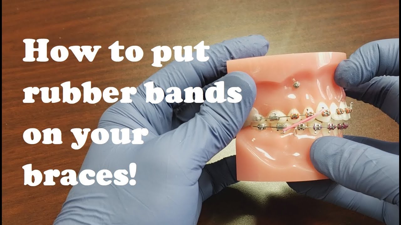 Tutorial: How to put rubber bands on your braces