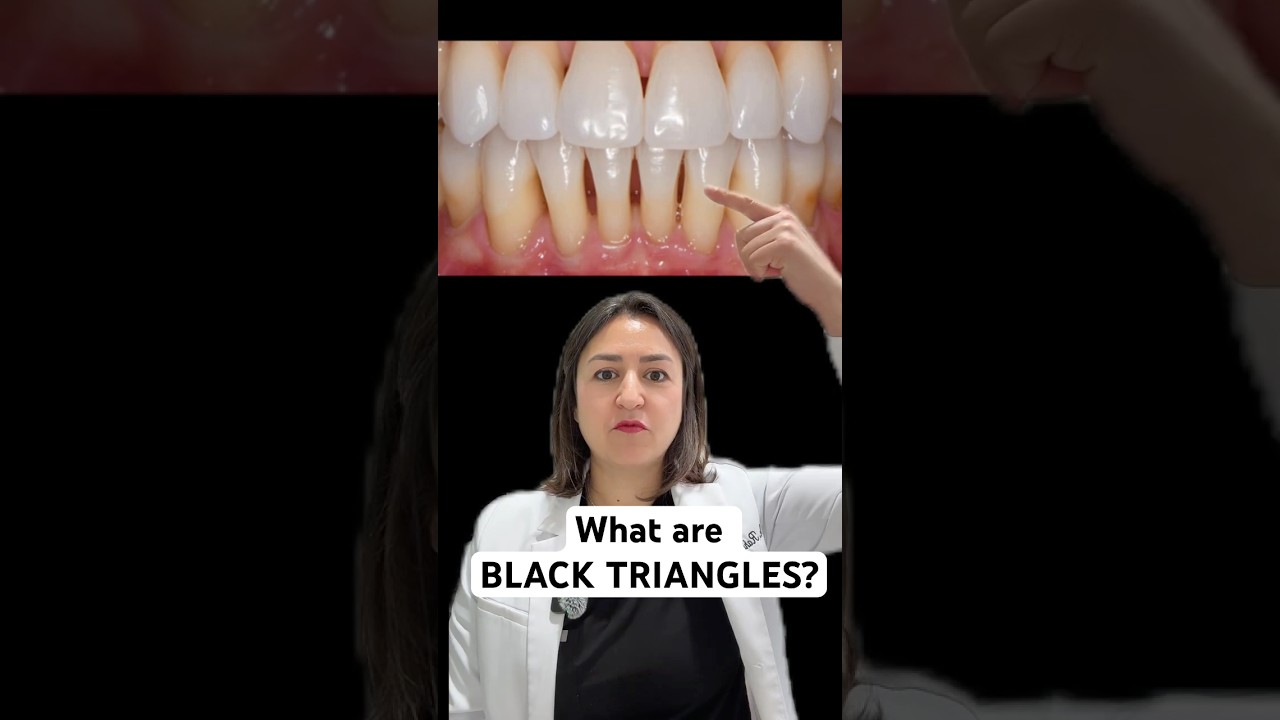 Noticing Little Black Gaps Between Your Teeth? It's Bone Loss |  District Dental Surgery