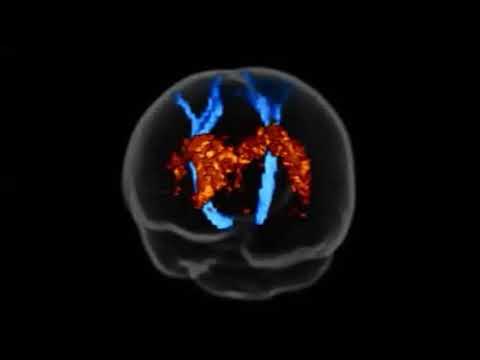 Punctate White Matter Lesions Associated With Altered Brain Development And Adverse Motor Outcome