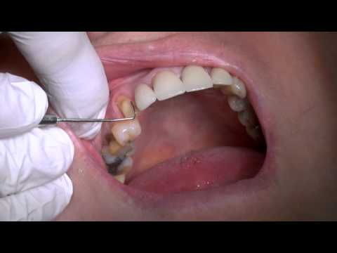 MiTi™ Crown and Bridge Solutions - Step by Step Guide