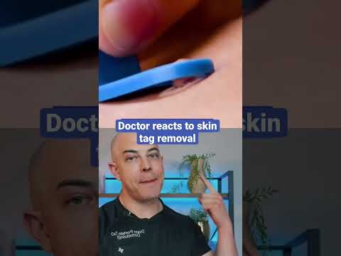 Doctor reacts to skin tag removal!