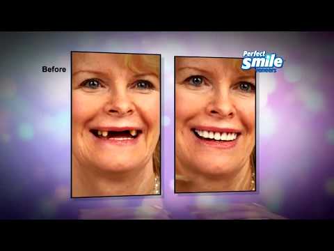 Dents de Remplacement Amovibles et Réutilisables, 1 acheté, 1 offert