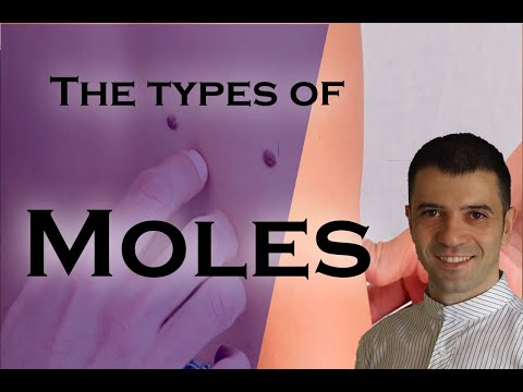 THE DIFFERENTS TYPES OF MOLES