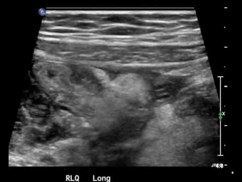 Appendicitis, Ultrasound Long. JETem 2017.