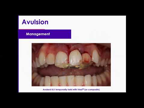 13. Traumatic Dental Injuries: Part 2: Luxation Injuries, Type 6: Avulsions