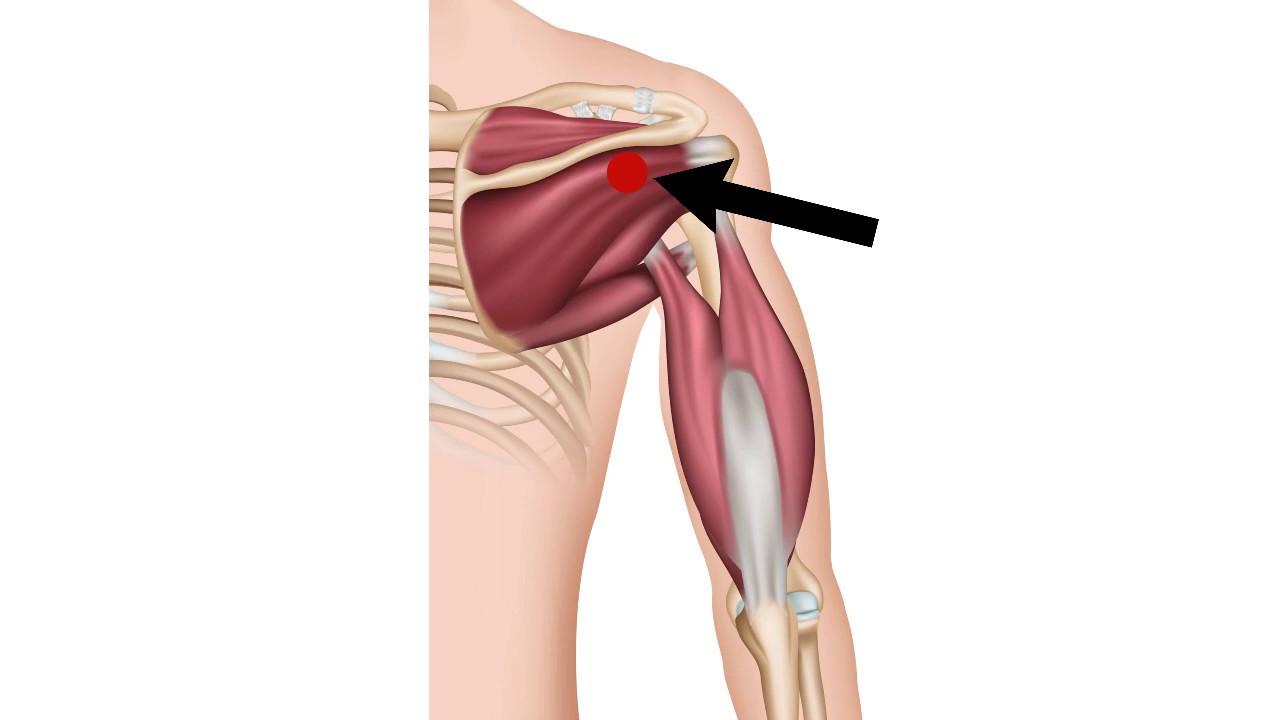 Infraspinatus - Trigger Point Anatomy