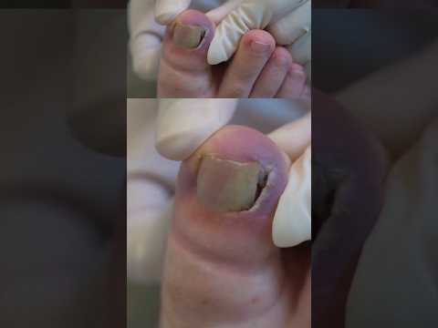 Bleeding of an ingrown nail can be made worse by doing this...