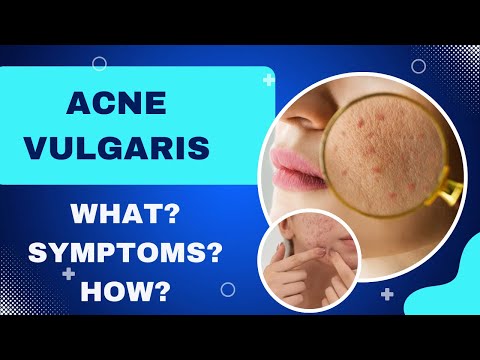 Acne vulgaris | clinical features | treatment for acne| pneumonics