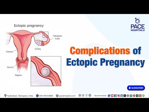 Complication of Ectopic Pregnancy | What are the risks of Ectopic Pregnancy? | #ectopicpregnancy