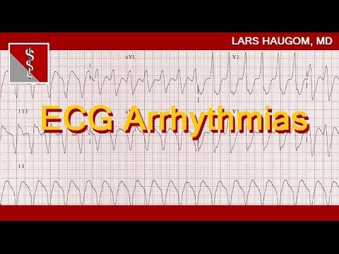 ECG Arrhythmias