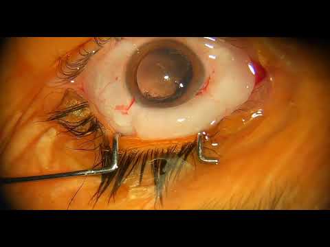 Grade 1 nuclear sclerosis (NS+1) cataract surgery
