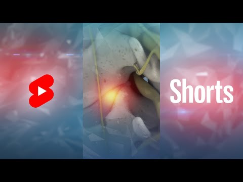 What is Cervical Degenerative Disc Disease? #Shorts